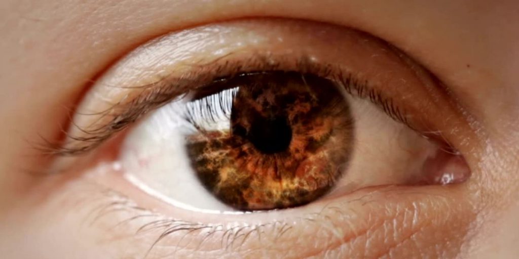 Cataracts and Diabetes - Causes of Cataracts, Symptoms & Treatment