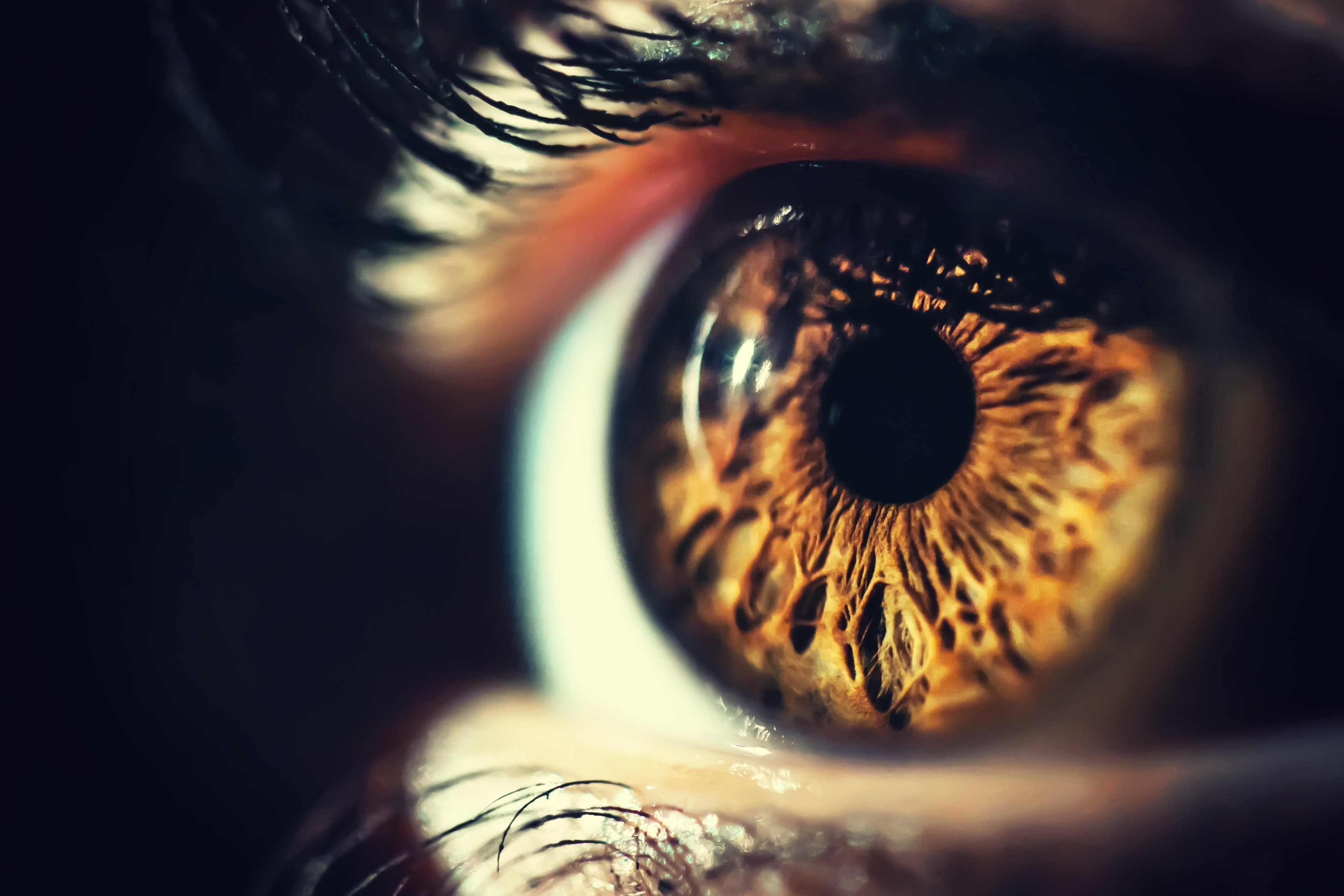 Cataracts and Diabetes - Causes of Cataracts, Symptoms & Treatment