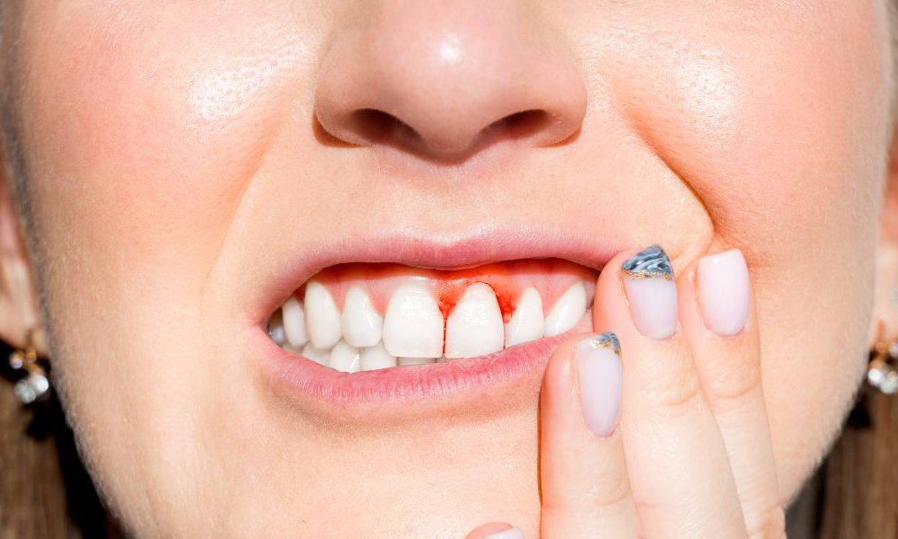 Gingivitis - Prevalence, Symptoms, Treatment