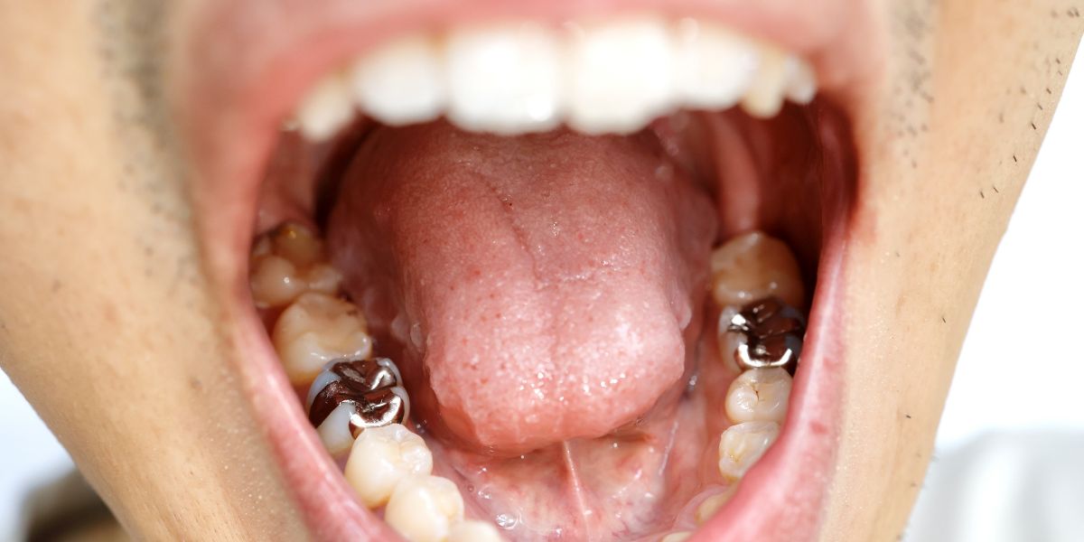 Rotten Teeth From Sugar